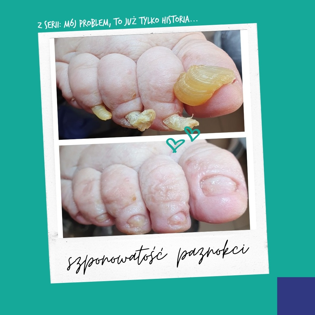 Czym jest ONYCHOGRYPHOSIS, czyli jak leczyć szponowatość paznokci ...